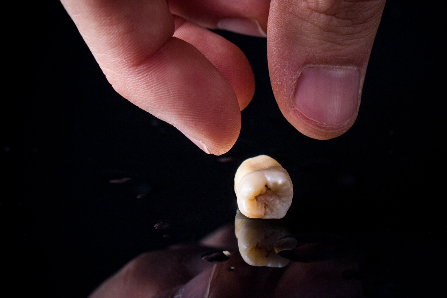 Impaktirani umnjaci | ARENA DENTAL